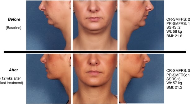 Beautytiptoday.com: Bye-Bye Double Chin: New Injectable Nearing Final ...