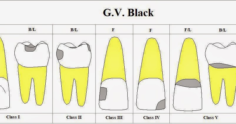 Clasificarea Black a cariilor dentare - Stomatologul de serviciu