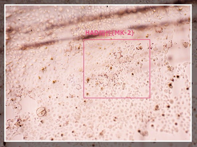 努力不一定會成功, 但成功一定需要努力!: 血球吸附試驗 (hemadsorption test, HAd)