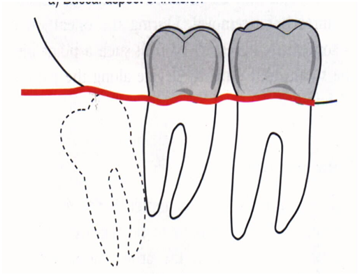 Dentistry and Medicine: Surgical management of Unerupted and Impacted teeth