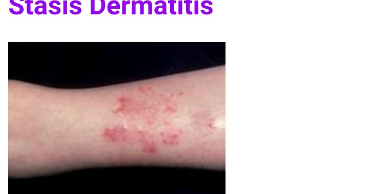 Stasis Dermatitis - www.24wikiss.blogspot.com