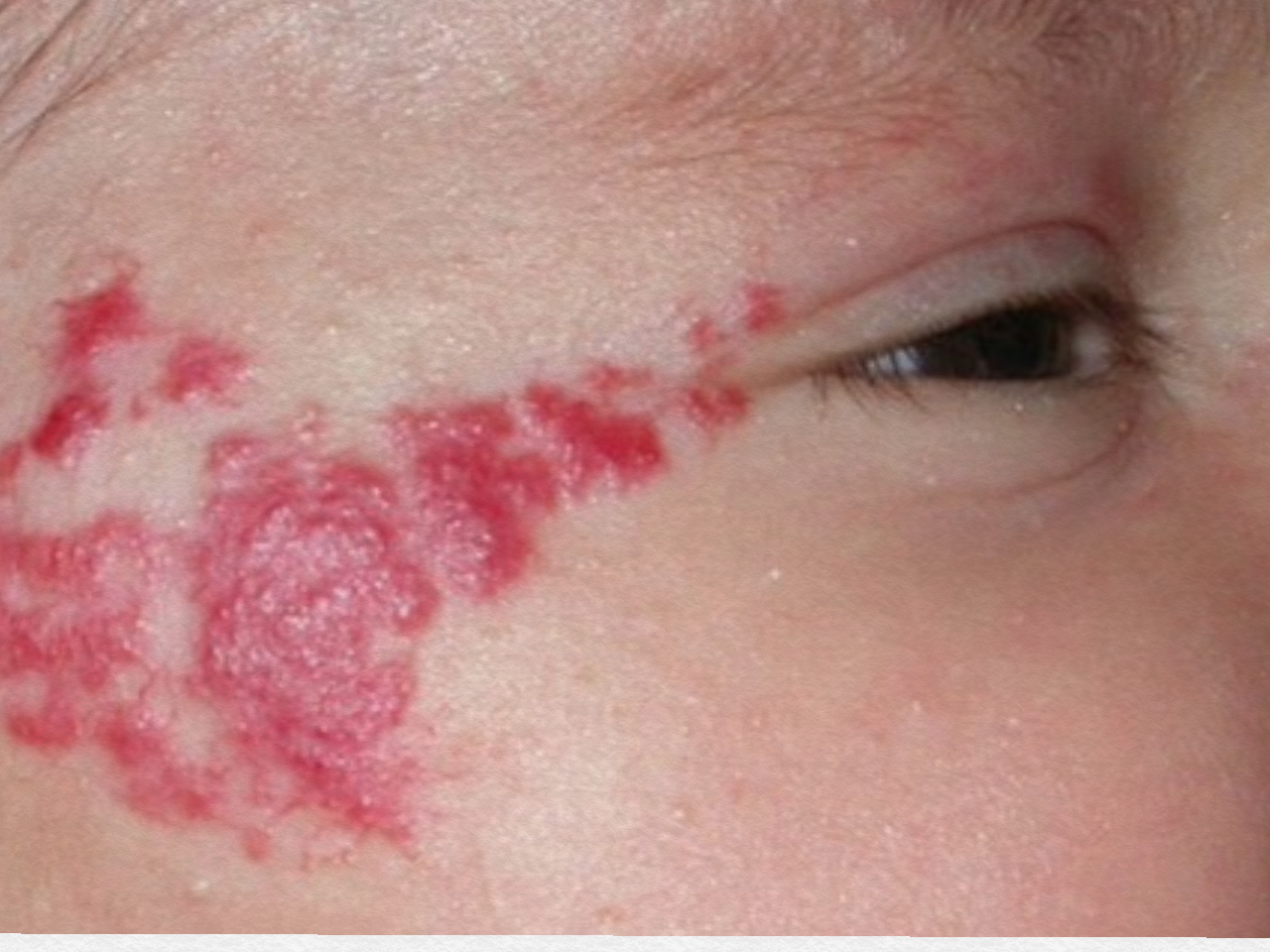 ¿Son peligrosos los angiomas cerca del ojo?