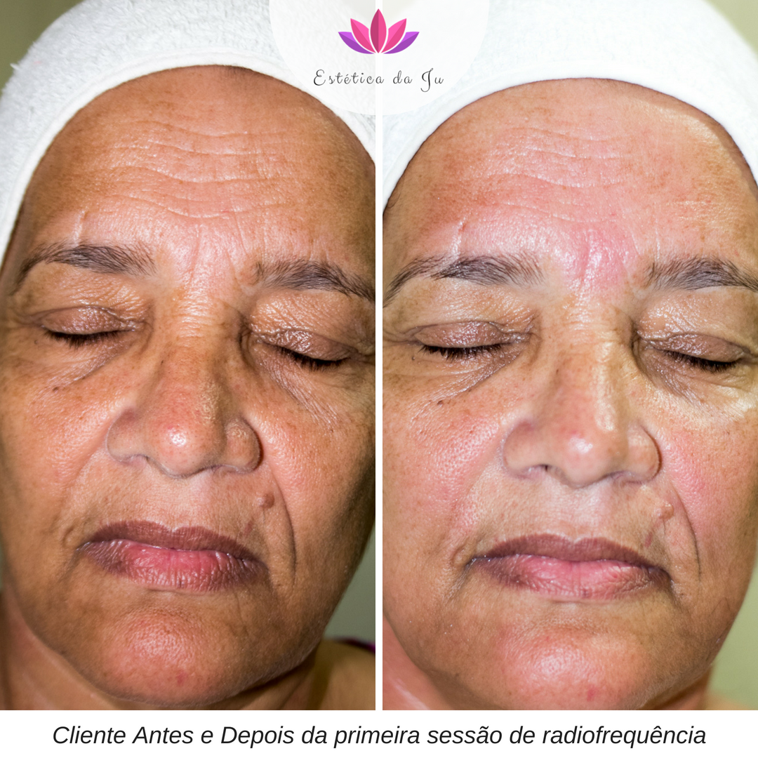 Estética da Ju: Radiofrequência para rejuvenescimento facial