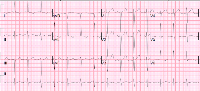 Dr. Smith's ECG Blog: May 2015
