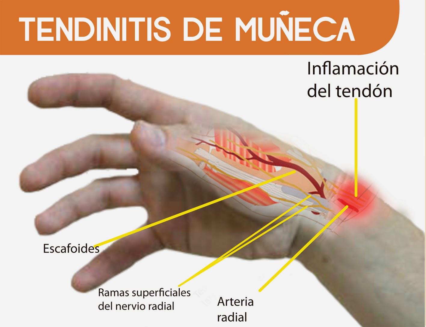 El Blog de Kike Yompian: La tendinitis y el túnel carpiano