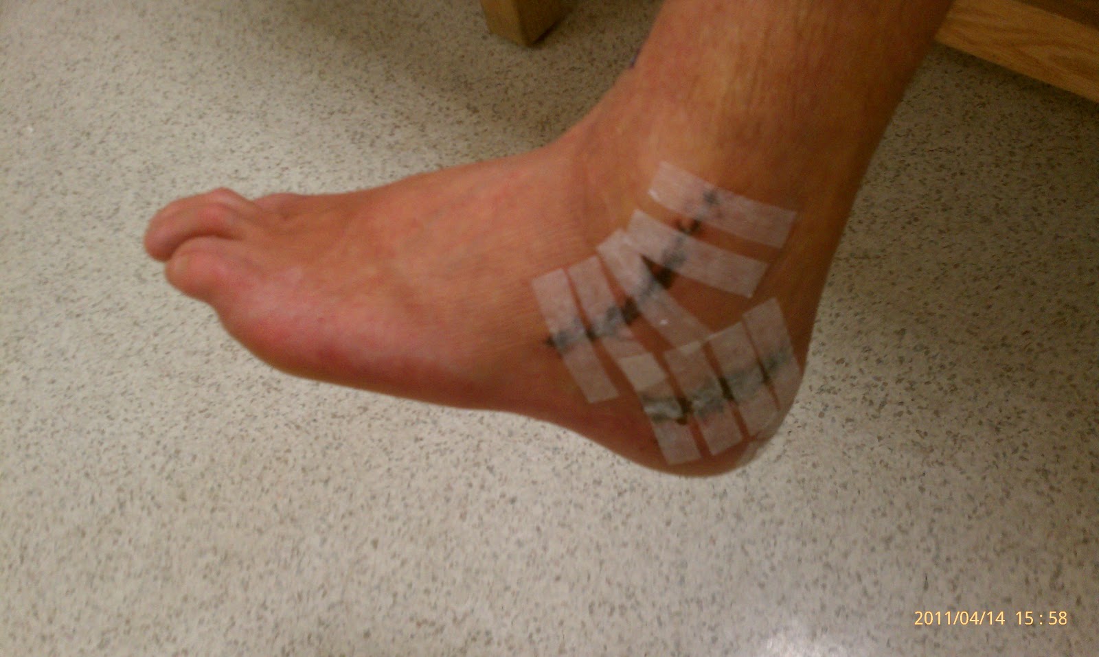 Sprained Ankle Leads to Surgery, CRPS, Amputations, and Disability: Day ...