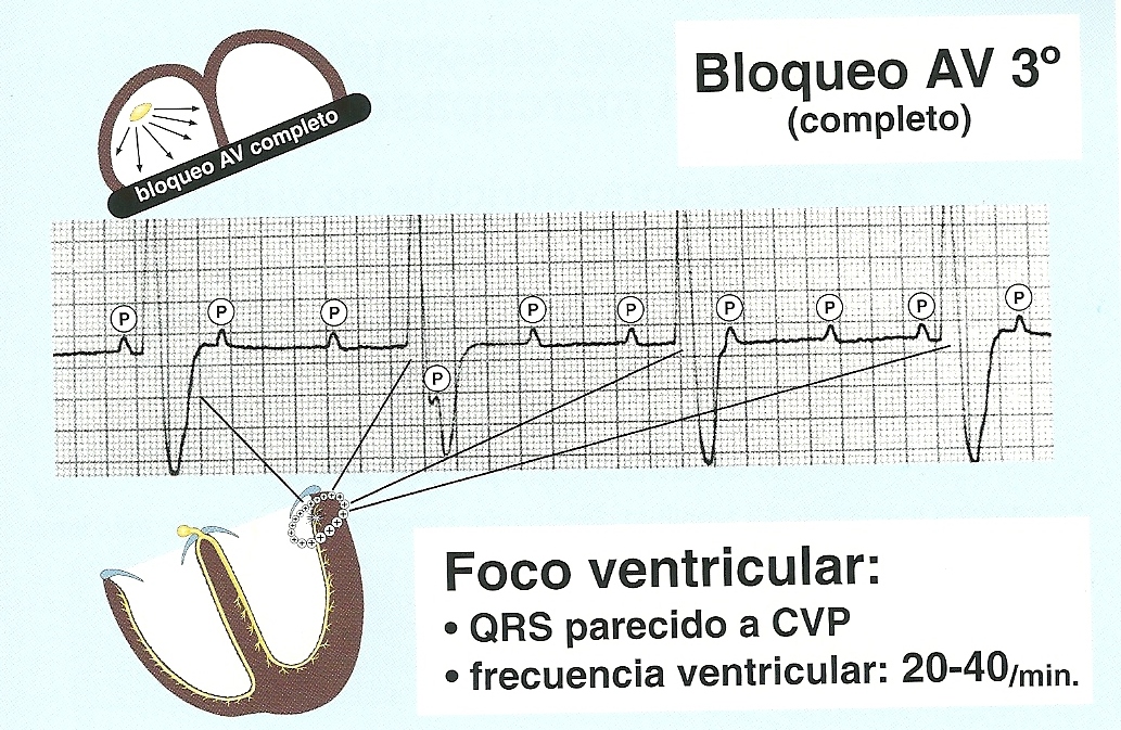 Electrocardiograma y Medicina General: Bloqueos Aurículo ventriculares