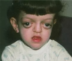 Medical Treatment Pictures-for Better Understanding: Crouzon Syndrome