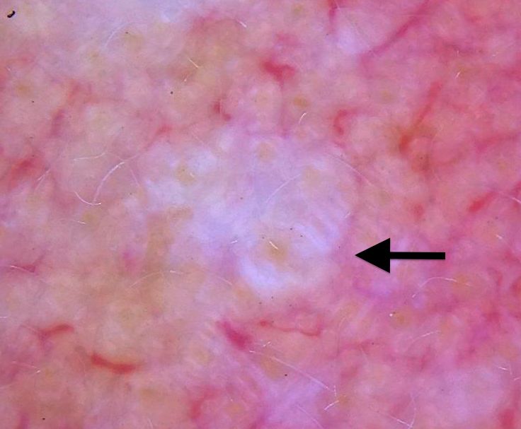 VIRTUAL GRAND ROUNDS IN DERMATOLOGY 2.0: Birt-Hogg-Dube Syndrome