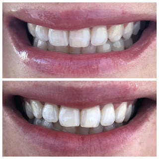 Love, Christin | A Lifestyle Momprenuer Blog: At Home Teeth Whitening ...