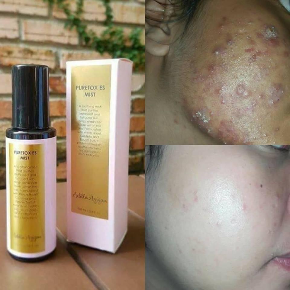 PURETOX ES MIST by ADILLA AZIZAN ORIGINAL MURAH | Harga Murah Original ...
