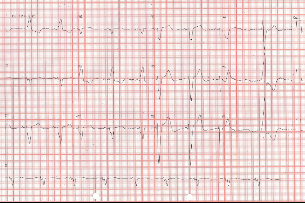 Blog de Eletrocardiografia: TERAPIA DE RESSINCRONIZAÇÃO VENTRICULAR