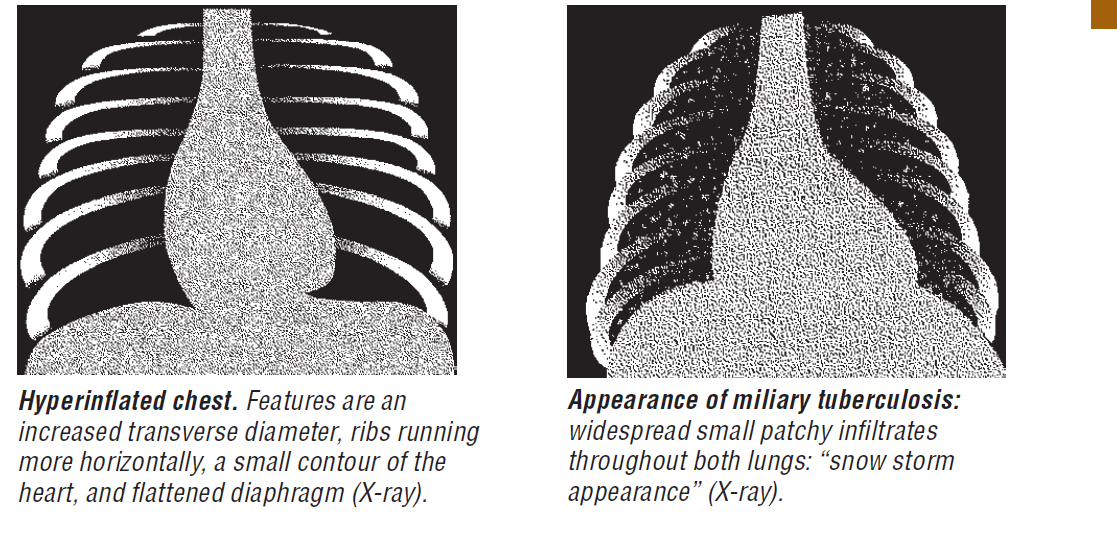 Pediatric Chest X Ray Basic Interpretation Made Easy ~ Nock Consultation