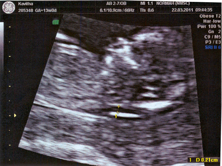 Ruthies's Journal: 13 Weeks Ultrasound Scan Photos