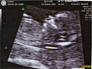 Ruthies's Journal: 13 Weeks Ultrasound Scan Photos