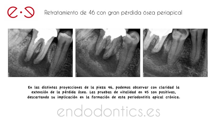 Endodoncia Microscópica en Zaragoza: Reendodoncia en 46 con gran ...