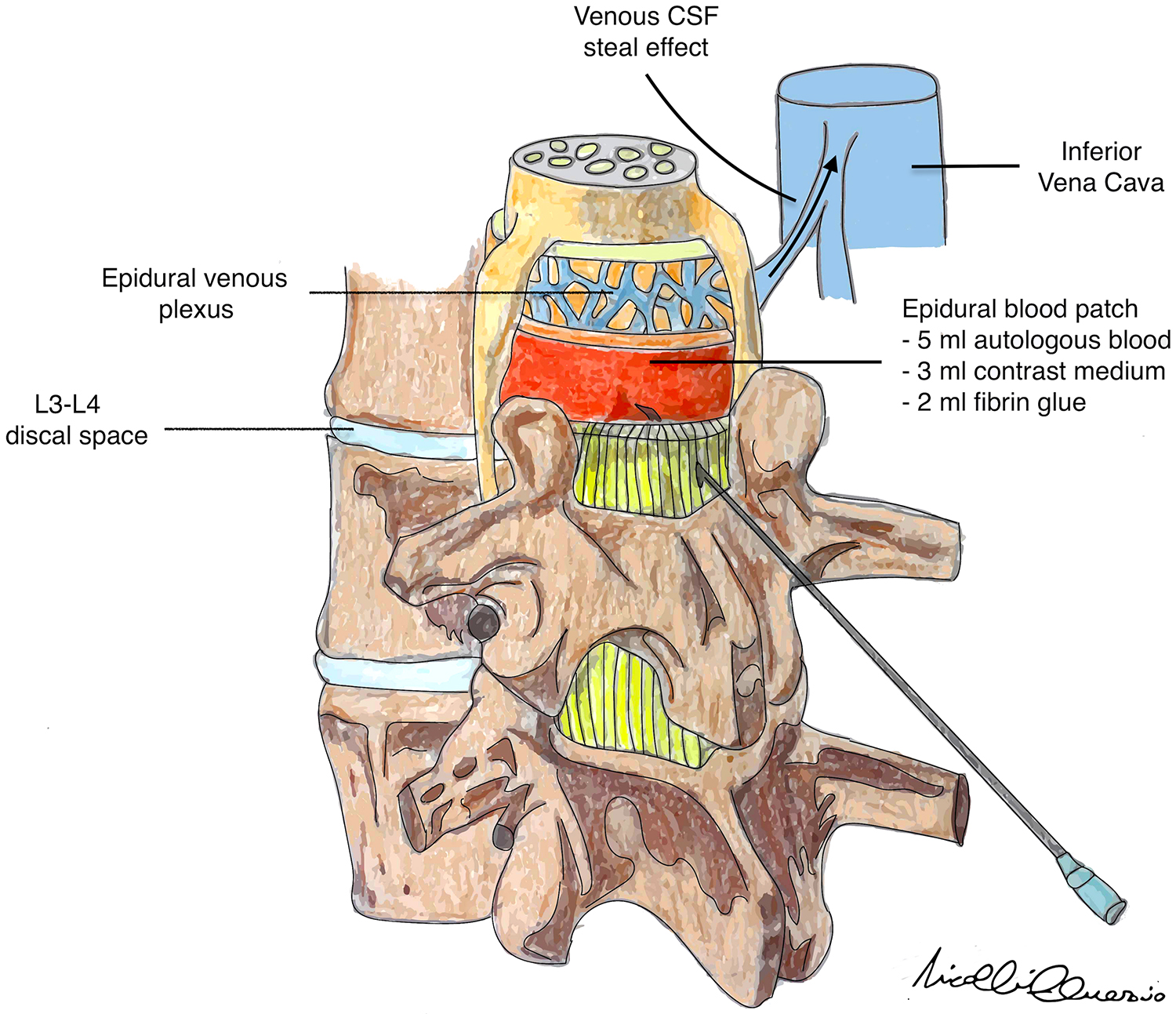 Brain drain for real: Adventures in cerebrospinal fluid leakage ...