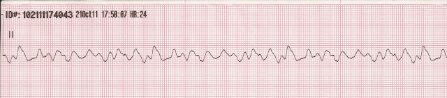 Pediatric Pulseless Ventricular Tachycardia (VT) and Ventricular ...