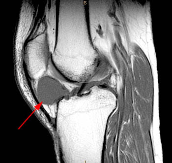 Radiology Pearls: Infrapatellar (Hoffa's fat pad) ganglion cyst