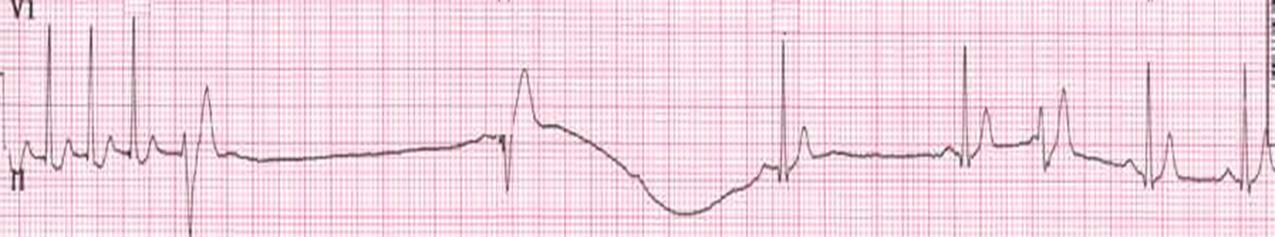 ACLS review: Wide Complex Tachycardia (WCT) Part 5