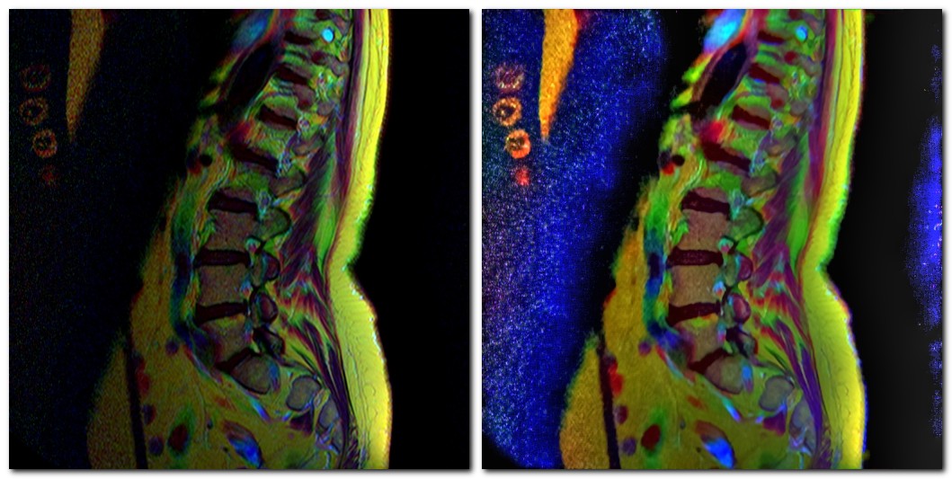 Nevit's blog: Color MRI of the Lumbar spine tonemapped.