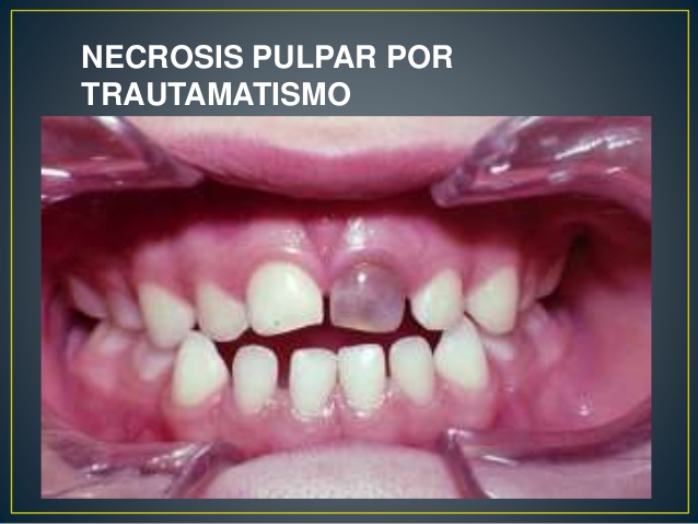 Clínica Dental Hernández Vela: La necrosis pulpar