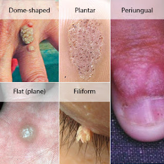 Moles, Warts & Skin Tags Removal: Types Of Warts And Treatment