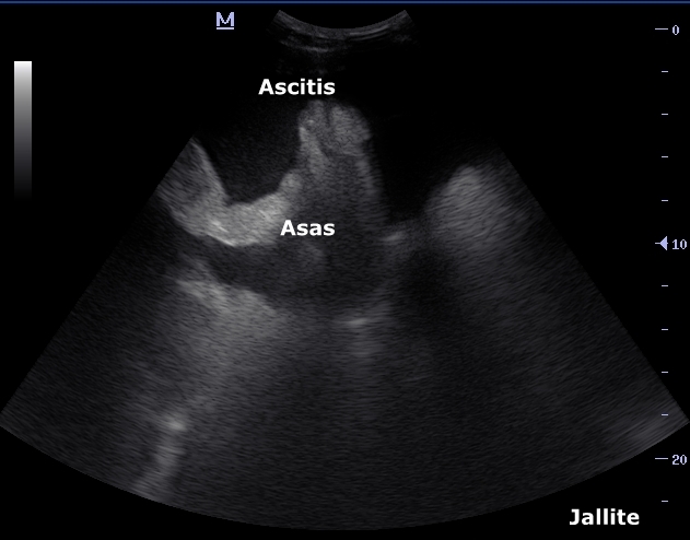 Cancer Hepatico & Ascitis Hematica