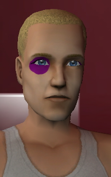 SOSFisio - o blog da saúde: Como tratar um olho roxo