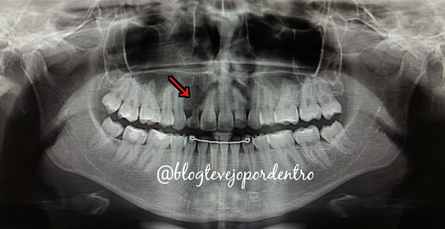 "Te vejo por dentro": Imagem Radiográfica da Semana ( 118)