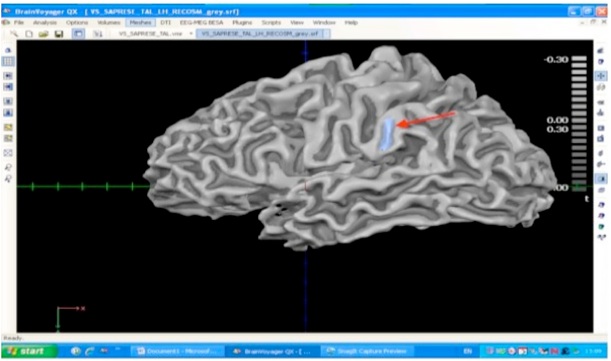 Neuroimaging Made Easy : Brainvoyager QX tips and tricks 1; Some ...