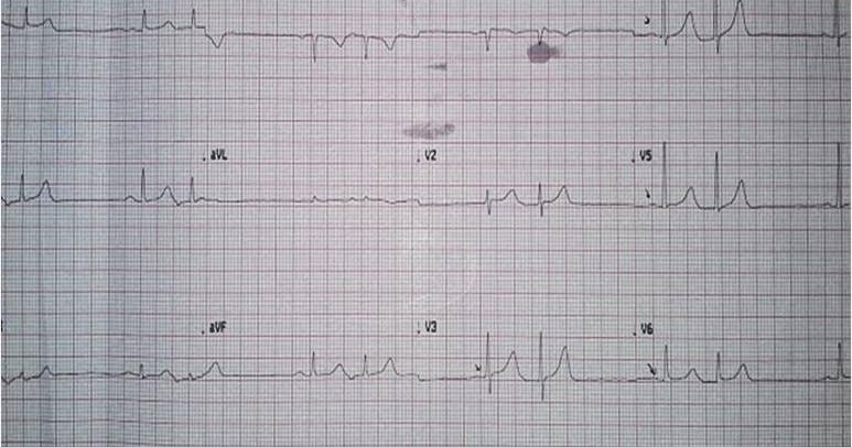 Phimaimedicine: 2,803 Atrial ectopic beats (premature extrasystoles)