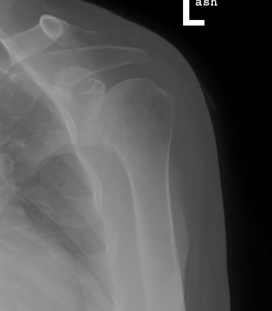 Shoulder and Elbow Surgery: Impaction autografting of the medial calcar ...