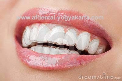 Retainer transparan / invisible di Yogyakarta ~ AF Dental Laboratory ...