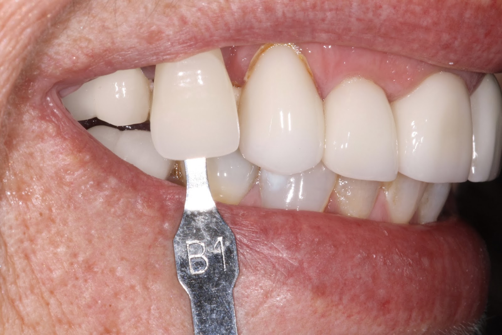 Crescent Dental on Blogspot!: E.Max Porcelain Crowns, Bridge and Veneers