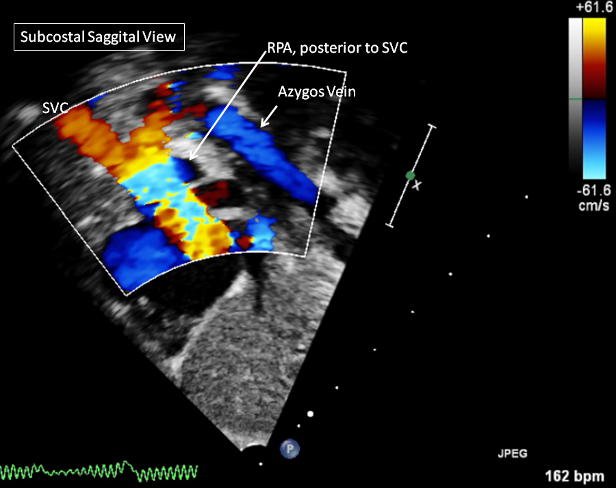 Pedi cardiology: Anatomy: Interrupted IVC with Azygos Vein Continuation