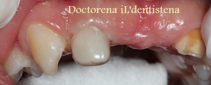 My Dental Diary: Strip Crowns