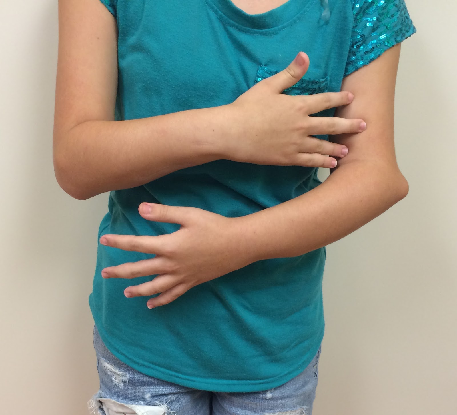 Multiple Hereditary Exostosis- Its Not Always about the X-rays ...