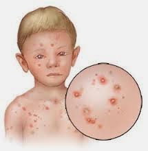 Cara Atasi Campak | Blog Kesehatan & Pengobatan