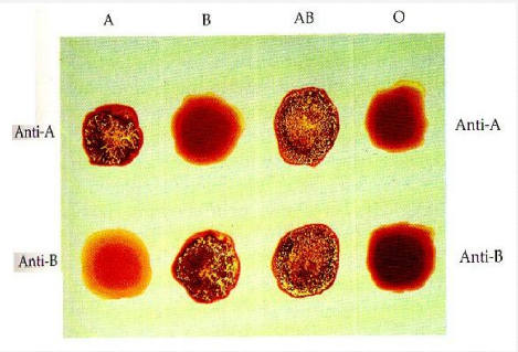 medical analysis laboratory: blood groups types explained and test ...