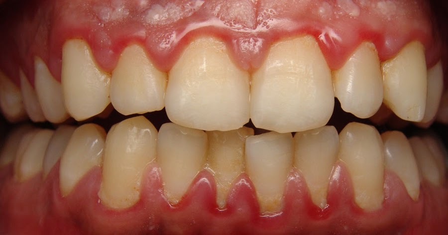 3 Efficient And Natural Ways to Prevent Tartar Build-Up