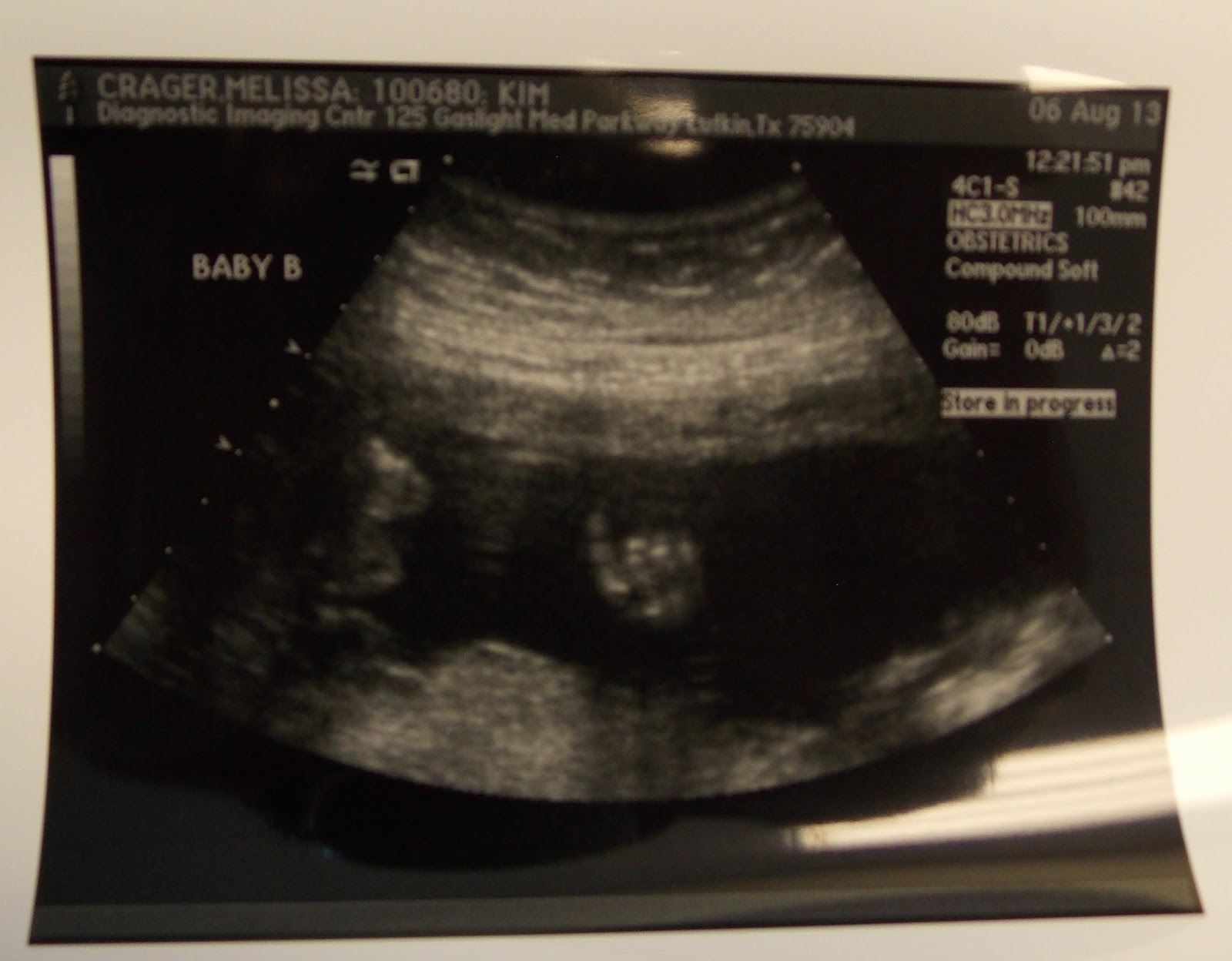 22 week ultrasound