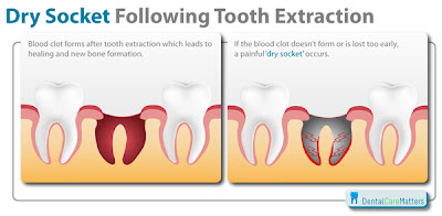 McDowell Mountain Ranch Dentistry: Dry Sockets and Wisdom Teeth