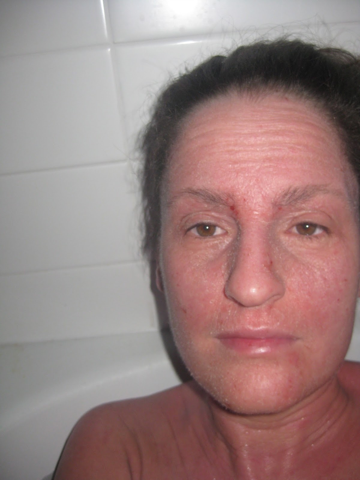 Topical Steroid Withdrawal Journey-Healing Eczema and Red Skin Syndrome ...