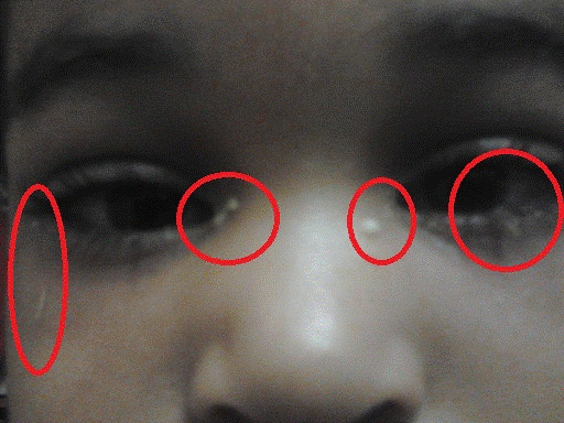 NATURES SERENDIPITY: Sea Salt Really Works for Pink Eye!