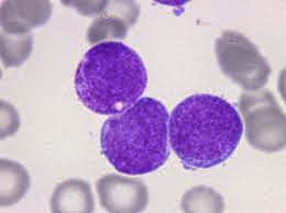 Series Celulares de Hematología: Leucemia Mieloide Aguda