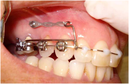 Blog do Tiago Padilha: Os mini-implantes ortodônticos na ortodontia ...