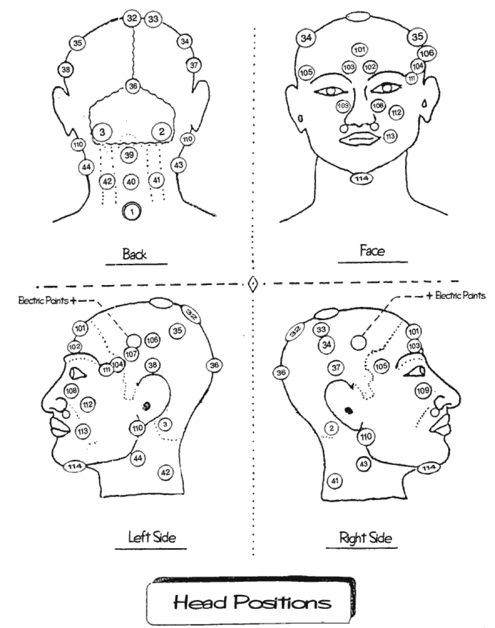 Rickynab Blog: Hijama (Cupping) Treatment Amazing Cure For All Diseases