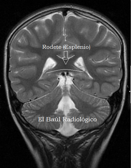 El Baúl Radiológico: EL CUERPO CALLOSO NORMAL. VARIANTES ANATÓMICAS ...