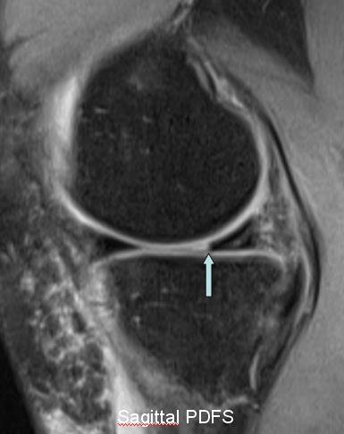 mricases: Radial Meniscal tear